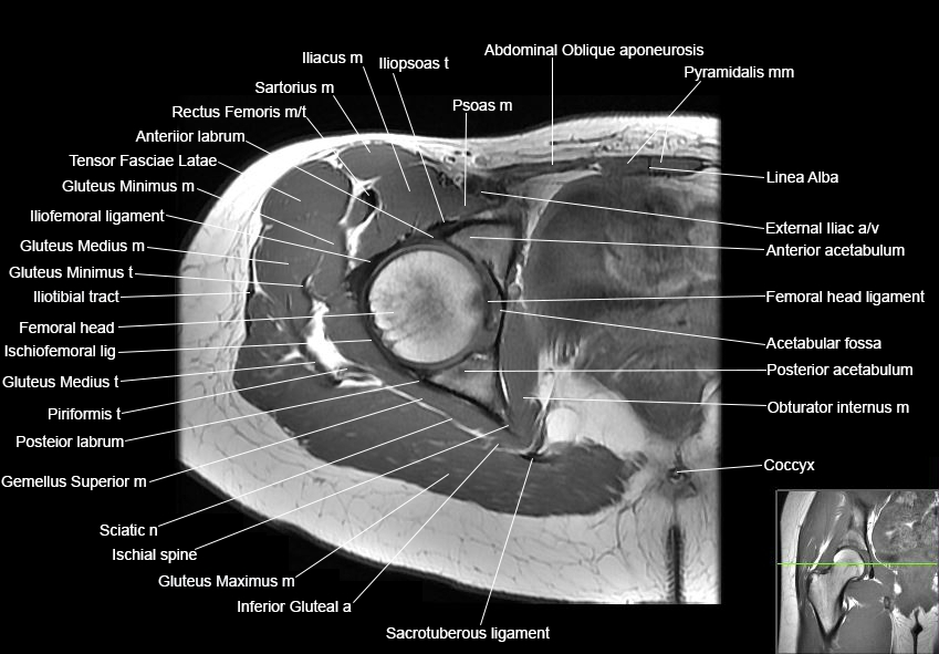 Mri Anatomy Of Hip Joint