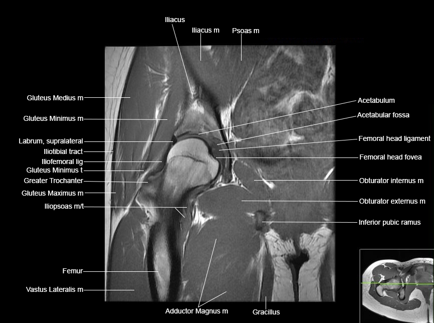 Normal Hip Mri