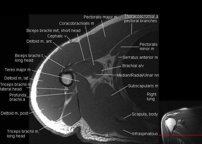 Scapula Anatomy Ct