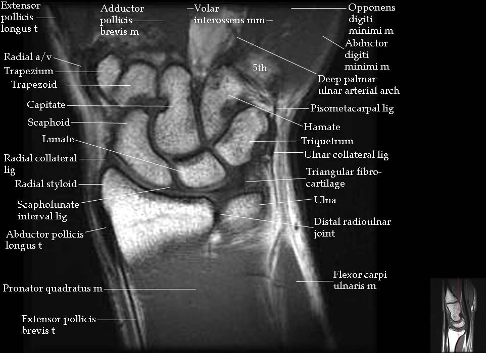 Mri Anatomy Wrist Radiology at Christy Redfield blog
